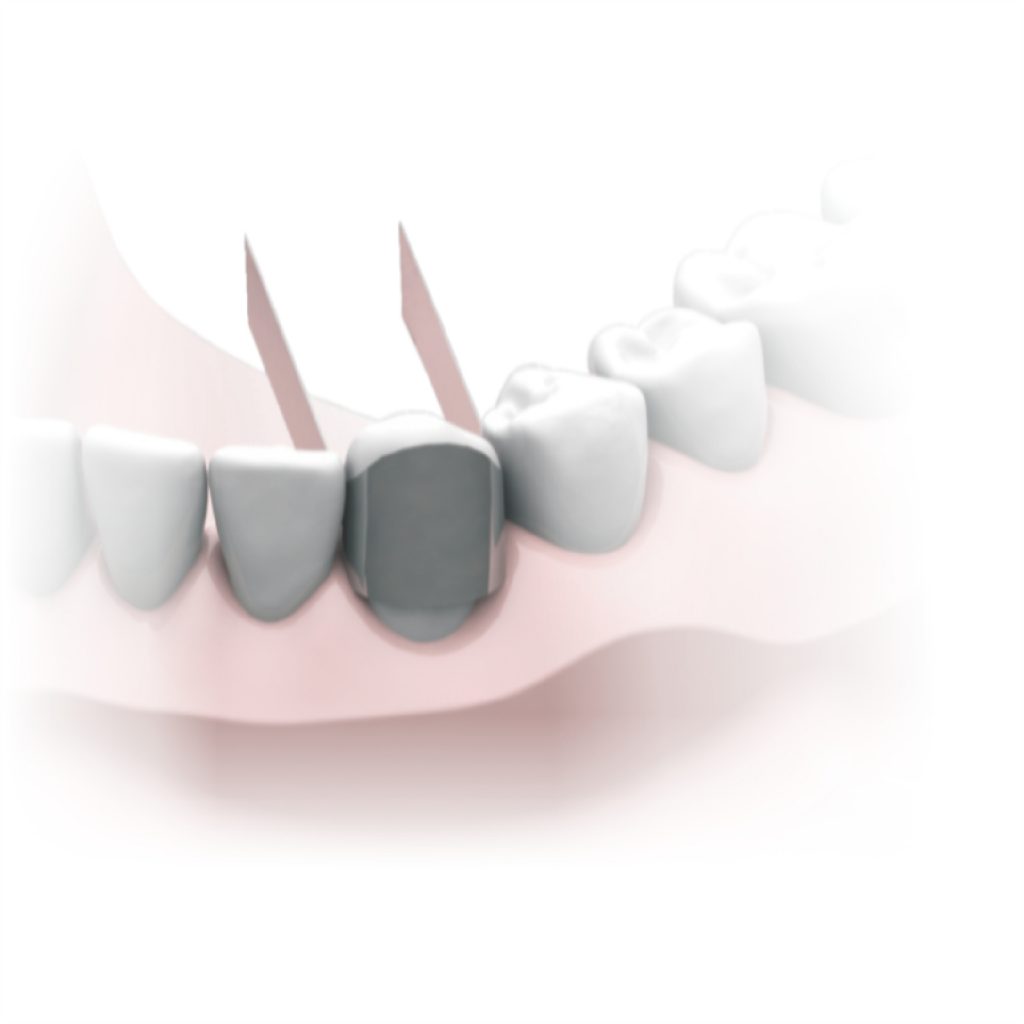 PREMOLAR BANDLAR – Ortomert
